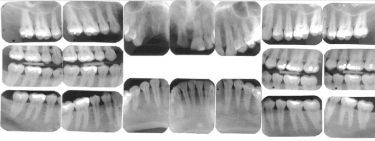 X-Rays & Radiographs – Oceansight Dental & Implants