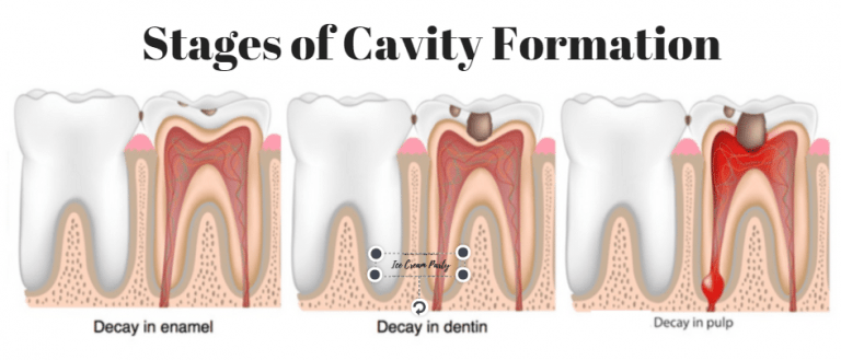 Dental Cavities – Oceansight Dental & Implants