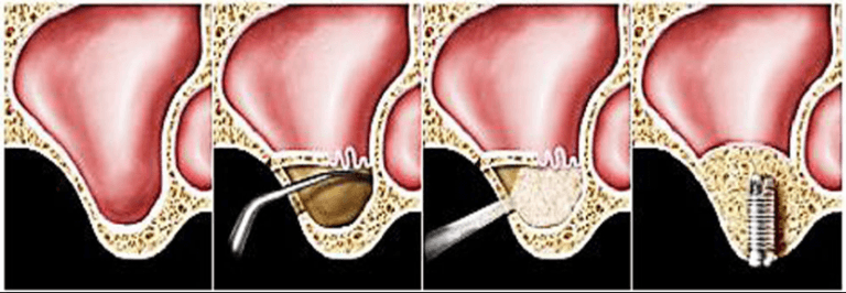Bone Grafts & Sinus Lift Procedures – Oceansight Dental & Implants