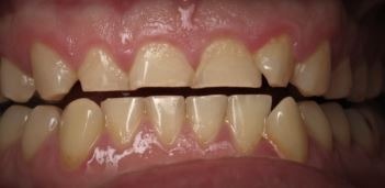 Inlays & Onlays – Oceansight Dental & Implants