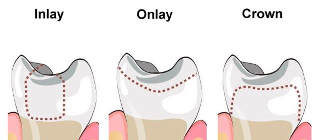 Inlays & Onlays – Oceansight Dental & Implants