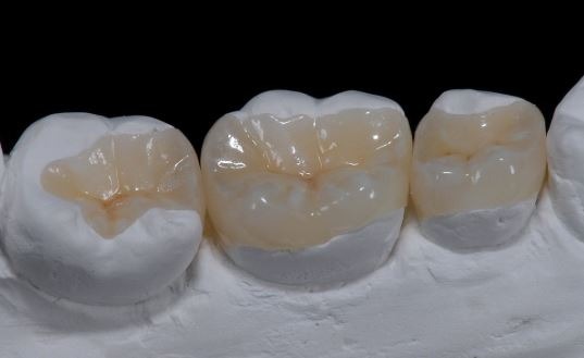 Inlays & Onlays – Oceansight Dental & Implants