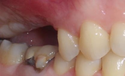 Inlays & Onlays – Oceansight Dental & Implants