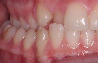 Inlays & Onlays – Oceansight Dental & Implants