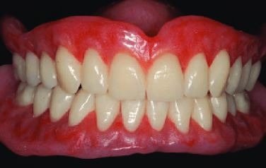 What are My Options if I Lose All of My Teeth? – Oceansight Dental ...