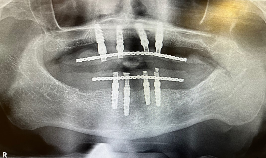 Study Case: All-on-4 Upper & Lower Teeth – Oceansight Dental & Implants