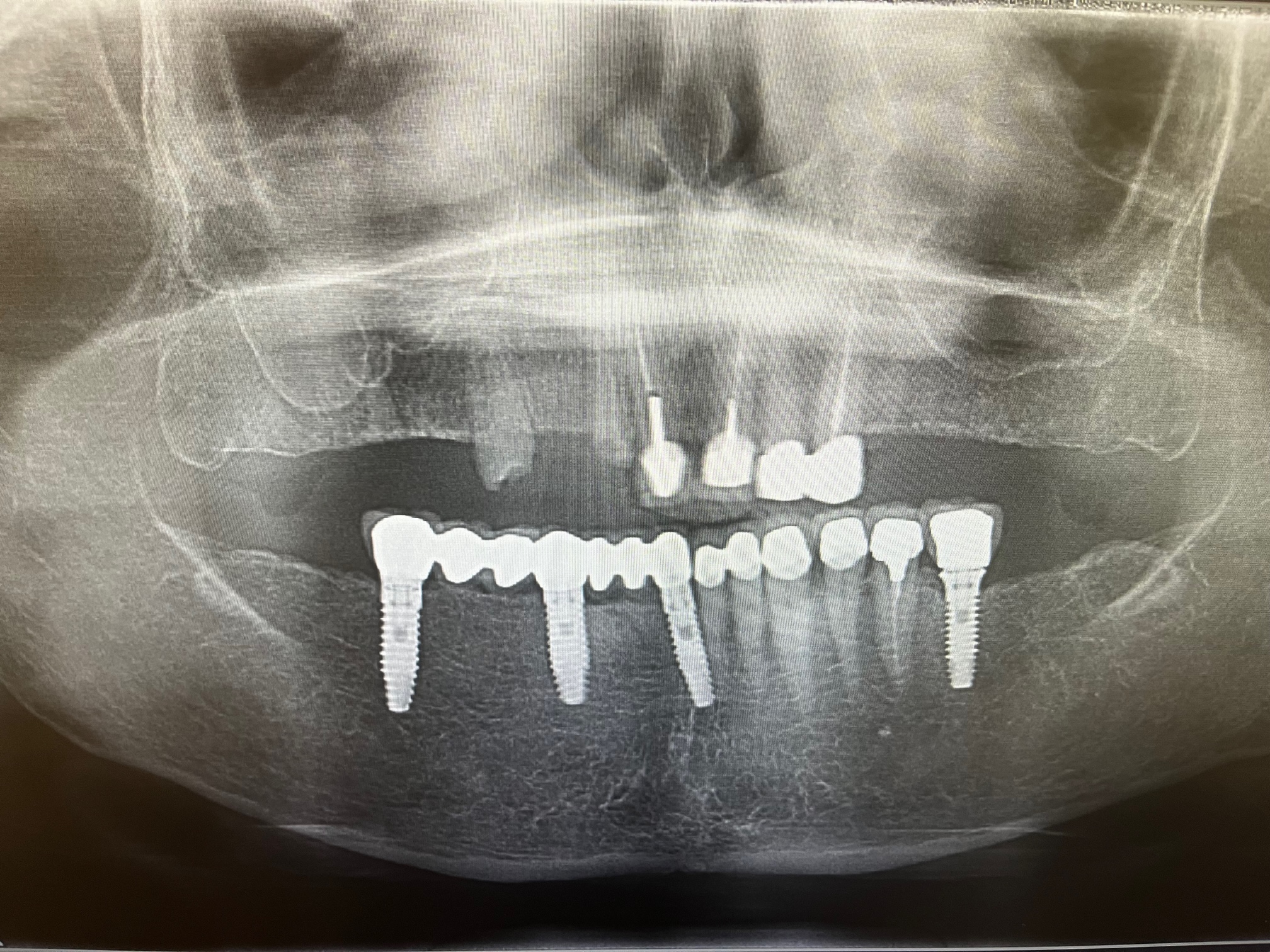 Study Case: All-on-5 Upper Zirconia Bridge – Oceansight Dental & Implants